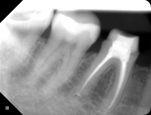 Revision einer unzureichenden Wurzelbehandlung (alio loco) | Zahnnotizen