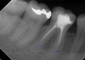 Revision einer unzureichenden Wurzelbehandlung (alio loco) | Zahnnotizen