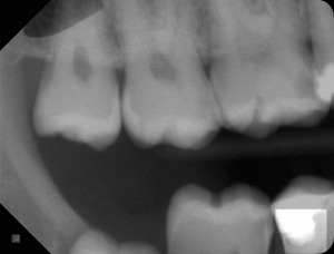 Karies unter alter Kunststofffüllung (alio loco) | Zahnnotizen