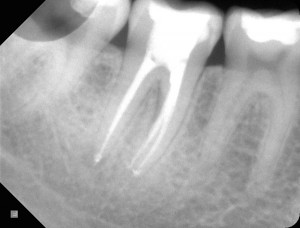 Revision einer Wurzelkanalbehandlung an Zahn 47 | Zahnnotizen