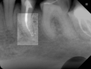 Revision einer Wurzelkanalbehandlung Zahn 35 (Endorevision) | Zahnnotizen