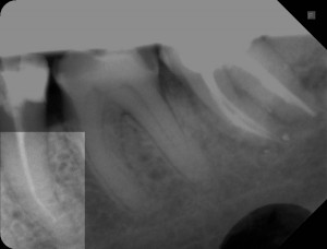 Revision einer Wurzelkanalbehandlung Zahn 35 (Endorevision) | Zahnnotizen