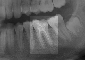 Revision einer Wurzelkanalbehandlung Zahn 36 (Endorevision) | Zahnnotizen