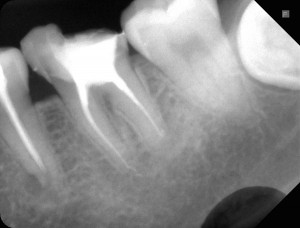 Revision einer Wurzelkanalbehandlung und abgebrochene Wand an Zahn 36 ...