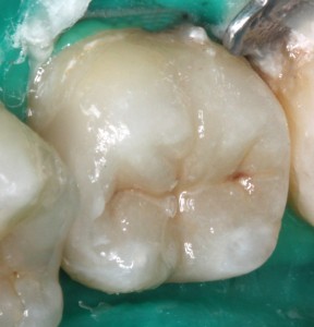 Keramikteilkronen Zahn 15 und 37 | Zahnnotizen