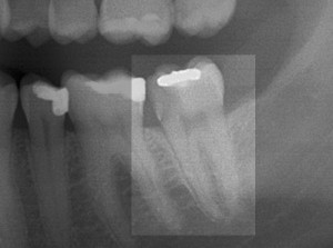 Wurzelkanalbehandlung an Zahn 37 | Zahnnotizen