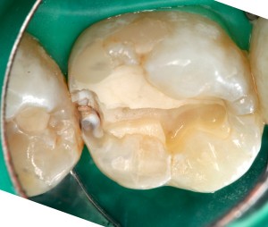 Komposit an Zahn 16 | Zahnnotizen