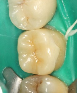 Keramikteilkrone Zahn 37 | Zahnnotizen