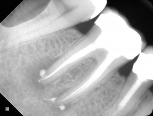 Revision einer Wurzelkanalbehandlung an Zahn 46 | Zahnnotizen