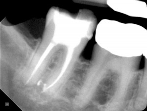 Wurzelkanalbehandlung an Zahn 47 | Zahnnotizen
