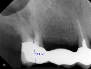 Revision einer alten Wurzelkanalbehandlung an Zahn 17 | Zahnnotizen