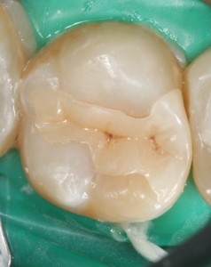 Keramik defektbezogen an Zahn 17 | Zahnnotizen