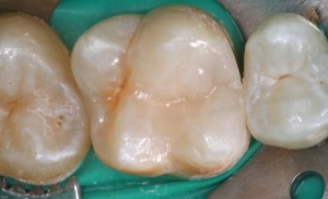 Komposit an Zahn 16 | Zahnnotizen