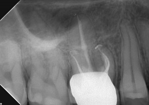 Revision einer Wurzelkanalbehandlung an Zahn 16 | Zahnnotizen