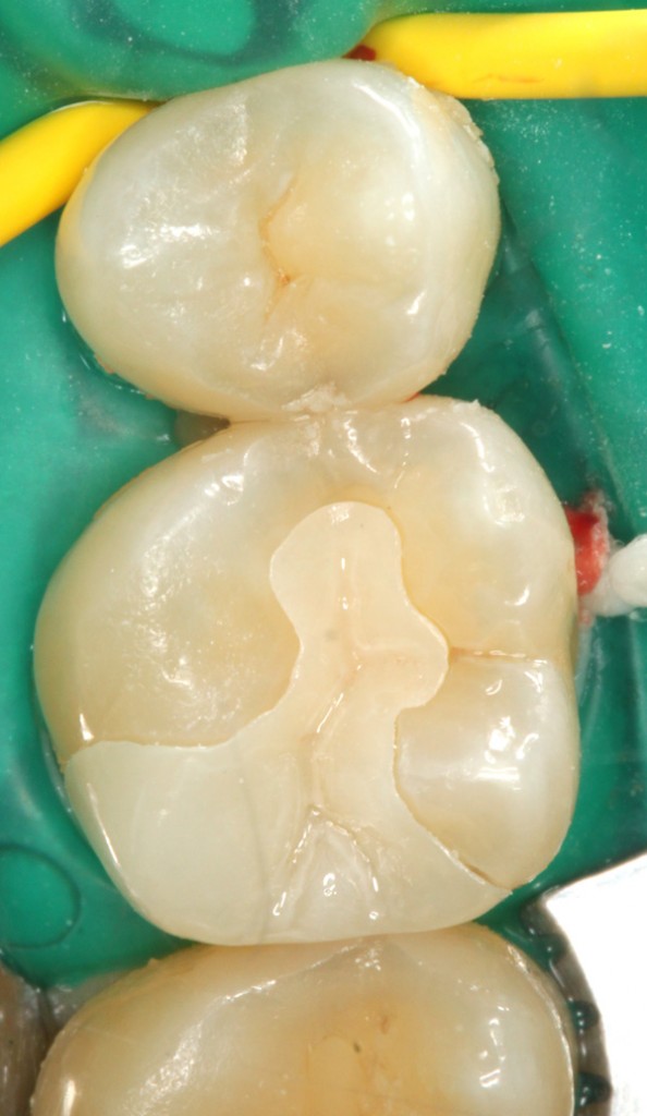 Keramikteilkrone für Zahn 16 | Zahnnotizen