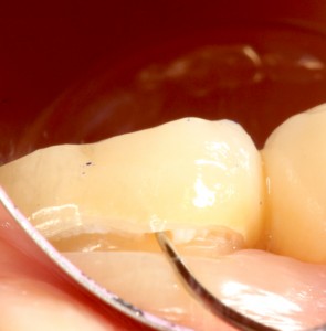 Randspalt an Keramikkrone (alio loco) | Zahnnotizen