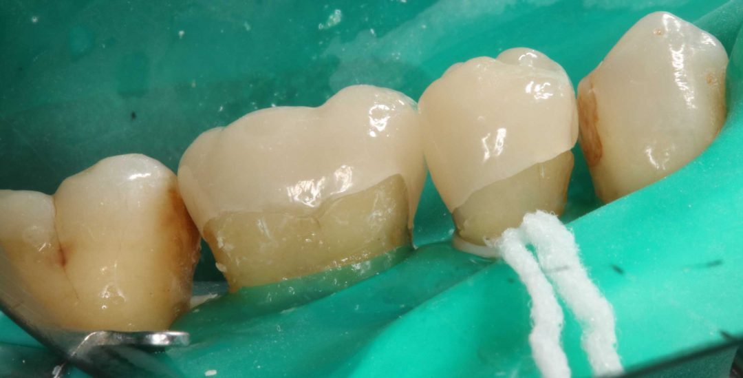 Keramikteilkronen | Zahnnotizen