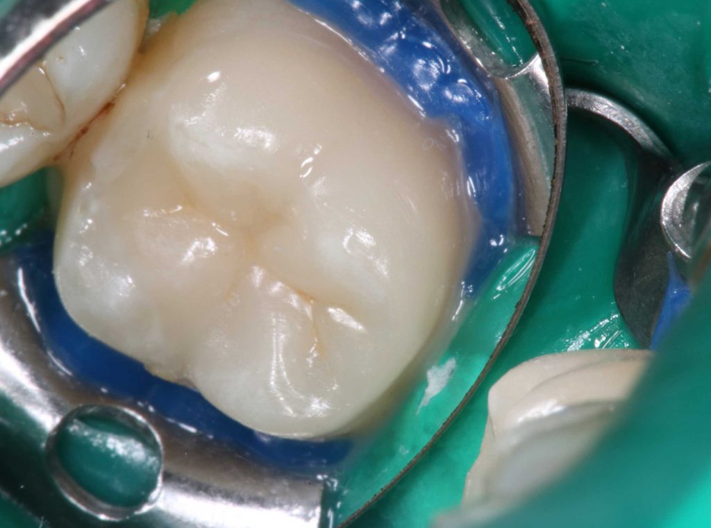 Keramikteilkrone Zahn 37 | Zahnnotizen