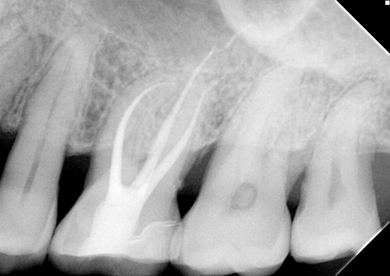 Wurzelkanalbehandlung | Zahnnotizen
