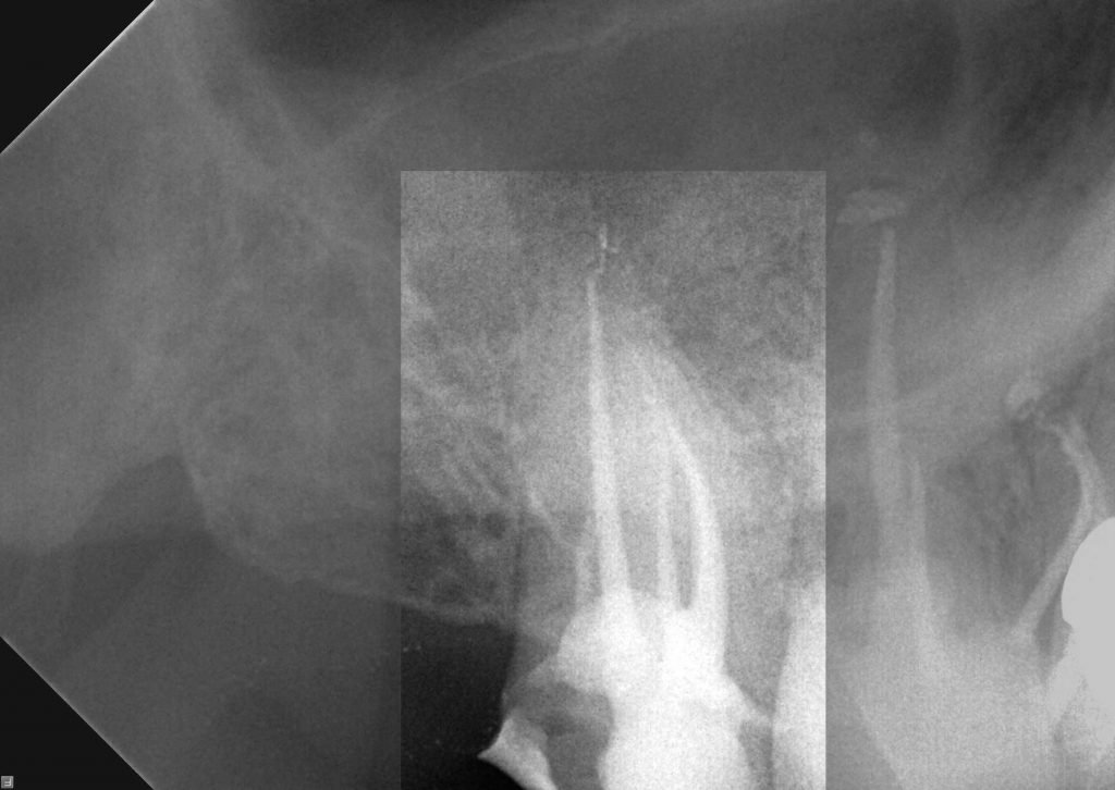 Wurzelkanalbehandlung | Zahnnotizen