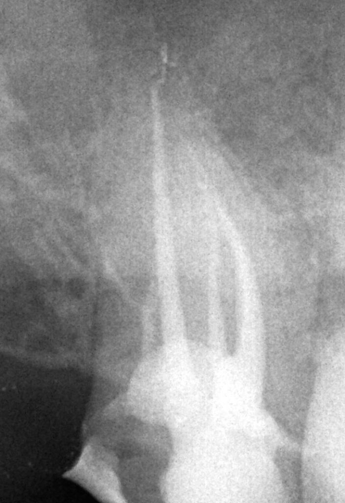 Wurzelkanalbehandlung | Zahnnotizen