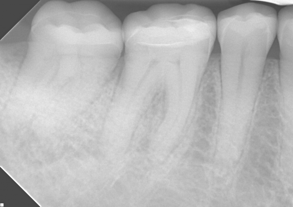 Drei mesiale Kanäle bei 46 | Zahnnotizen