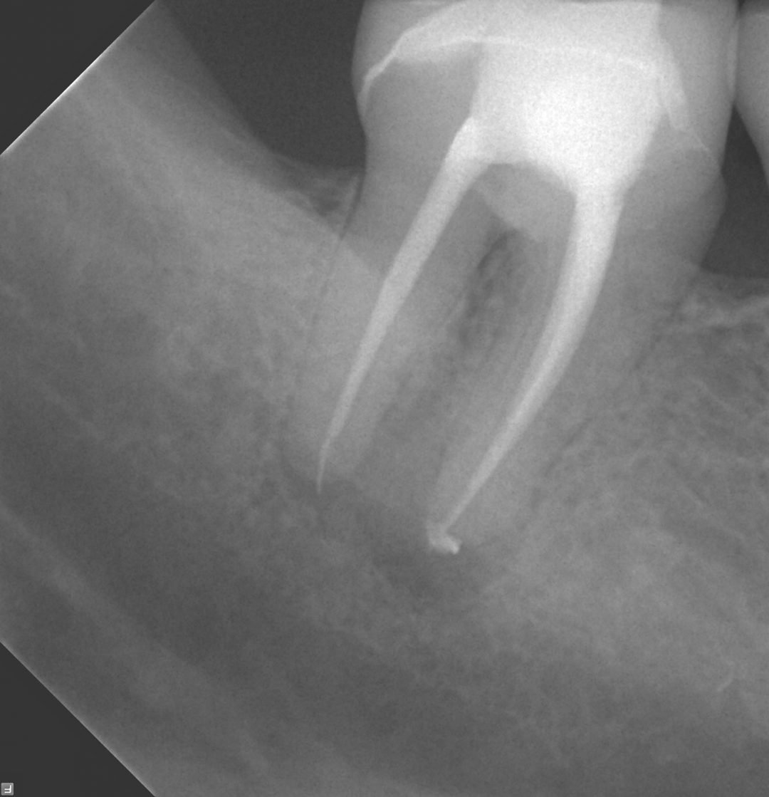 Wurzelkanalbehandlung | Zahnnotizen