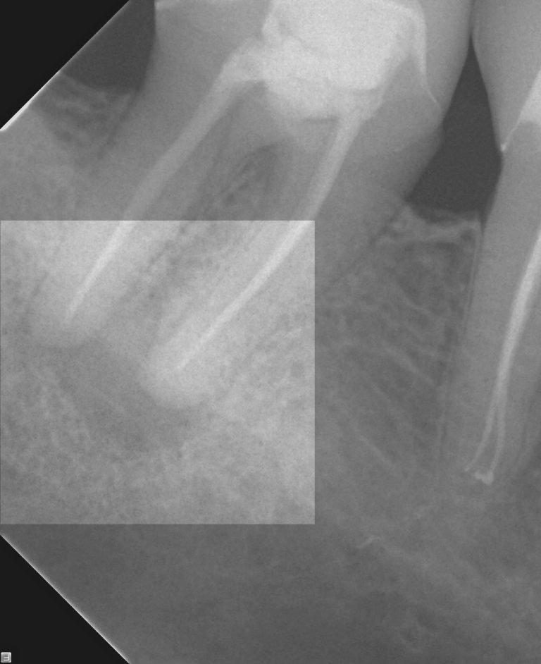 Endorevision an Zahn 47 | Zahnnotizen