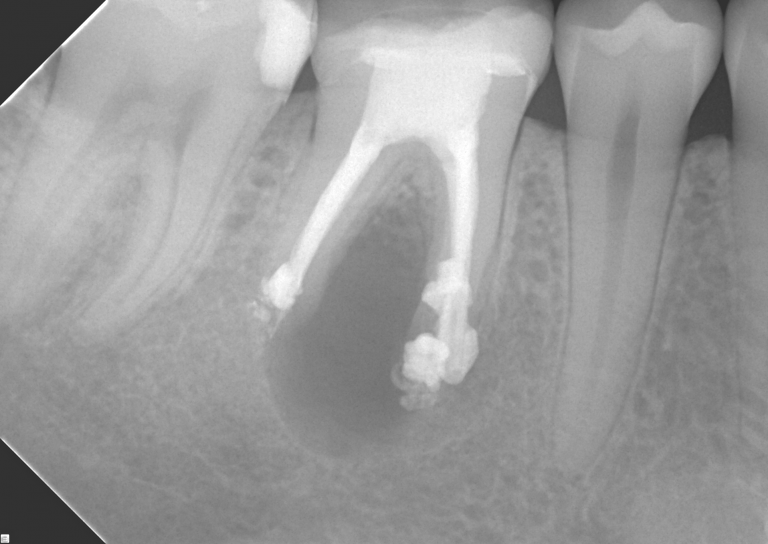 Zyste entfernt und Knochen aufgebaut | Zahnnotizen